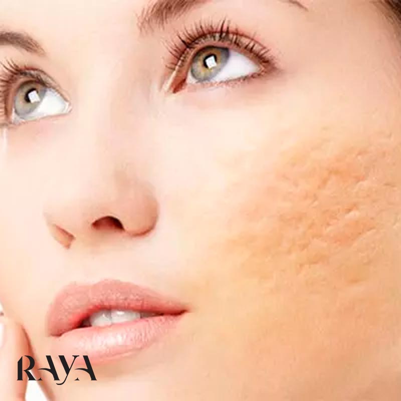 چگونه فرورفتگی جای جوش و آکنه ها را درمان کنیم؟